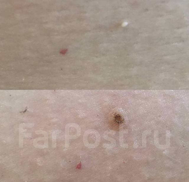 Удаление папиллом на лице, теле и в интимных местах! Возможен выезд во ...