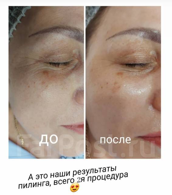 Губки от 7000р, Ботокс, Нитевой лифтинг, Мезотерапия, Биоревитализация ...