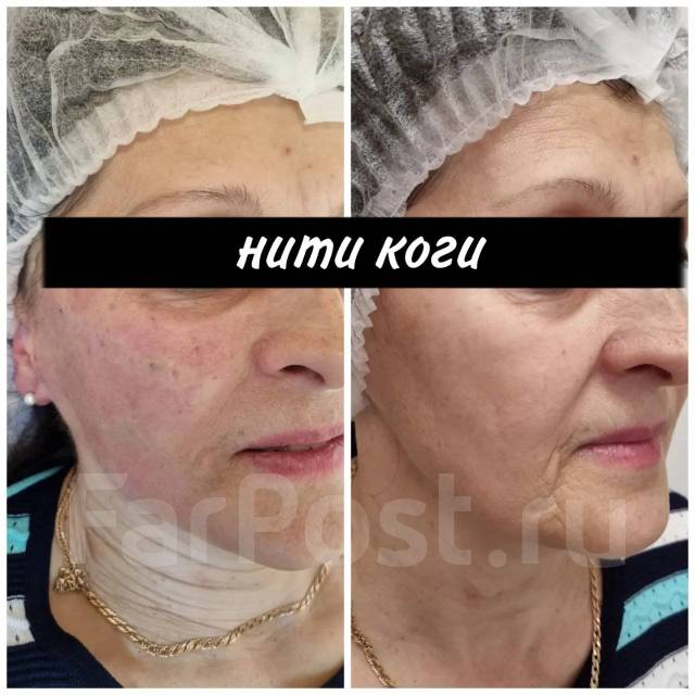 Губки от 7000р, Ботокс, Нитевой лифтинг, Мезотерапия, Биоревитализация ...