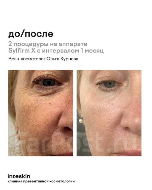Коррекция овала, подтяжка кожи, лифтинг эффект в клинике Inteskin во ...